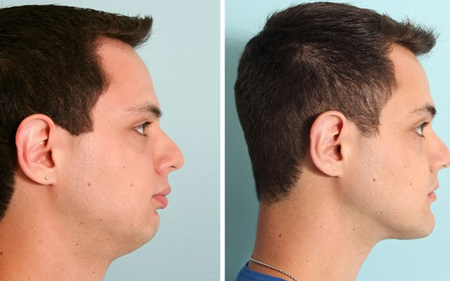 Bichectomie : Chirurgie Esthétique pour avoir la Mâchoire Carrée ...